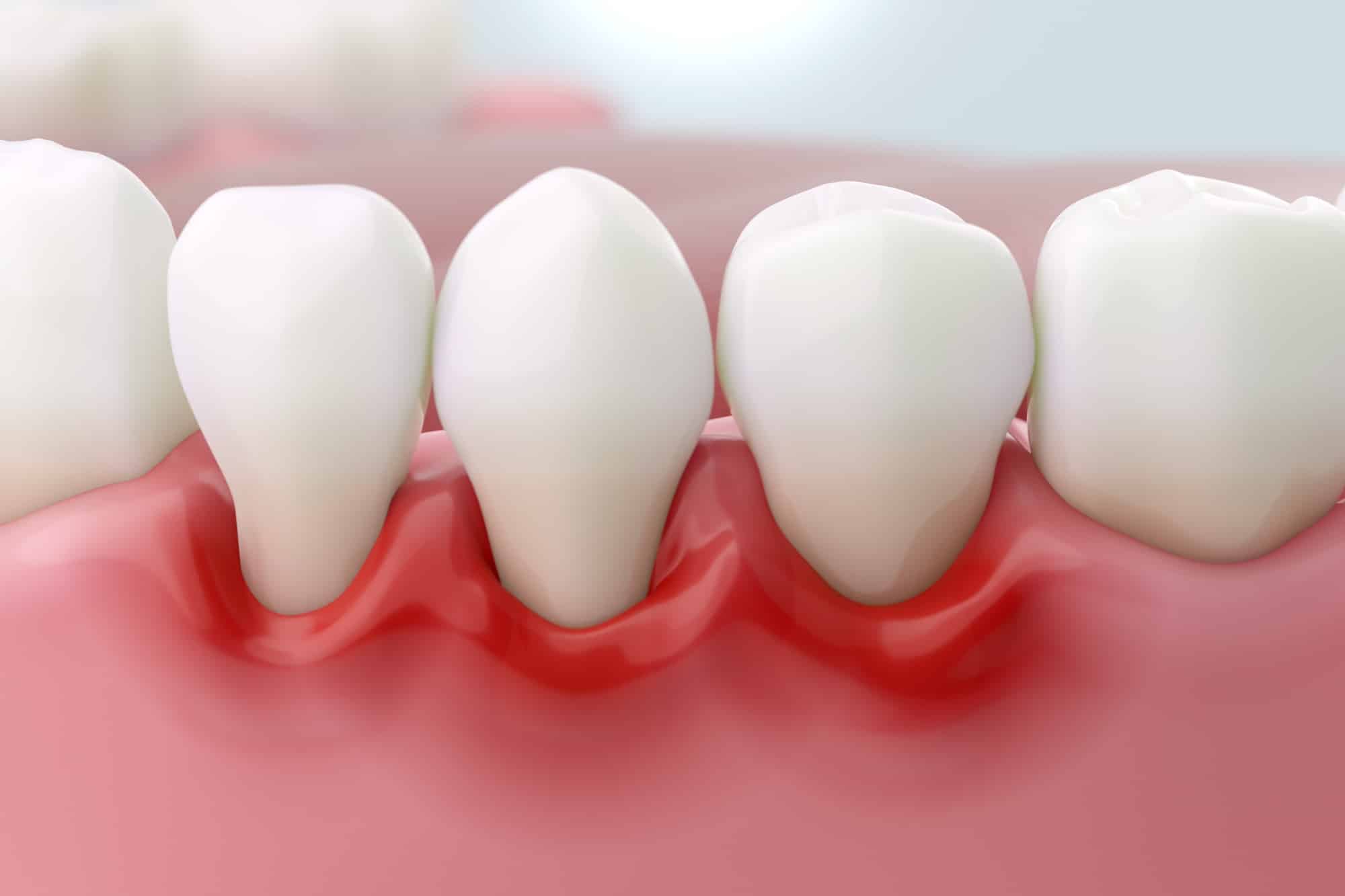 How to Get Rid of Gingivitis: A Treatment Guide - Smile Vegas Dental